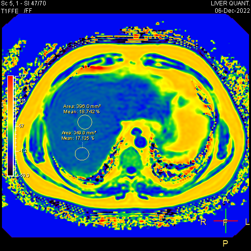 Liver Fat Quantification Mri at Chelsea Frome blog Liver Fat Quantification Mri at Chelsea Frome blog